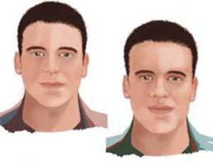 Acromégalie : Causes, origines et évolution