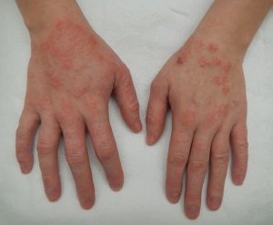 Dermites de contact professionnelles : symptômes, causes et traitement