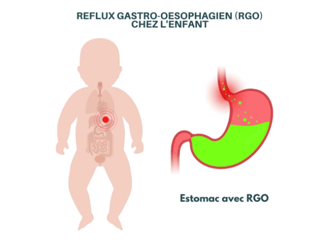Le reflux gastrique oesophagien (RGO) chez l'enfant est dangereux
